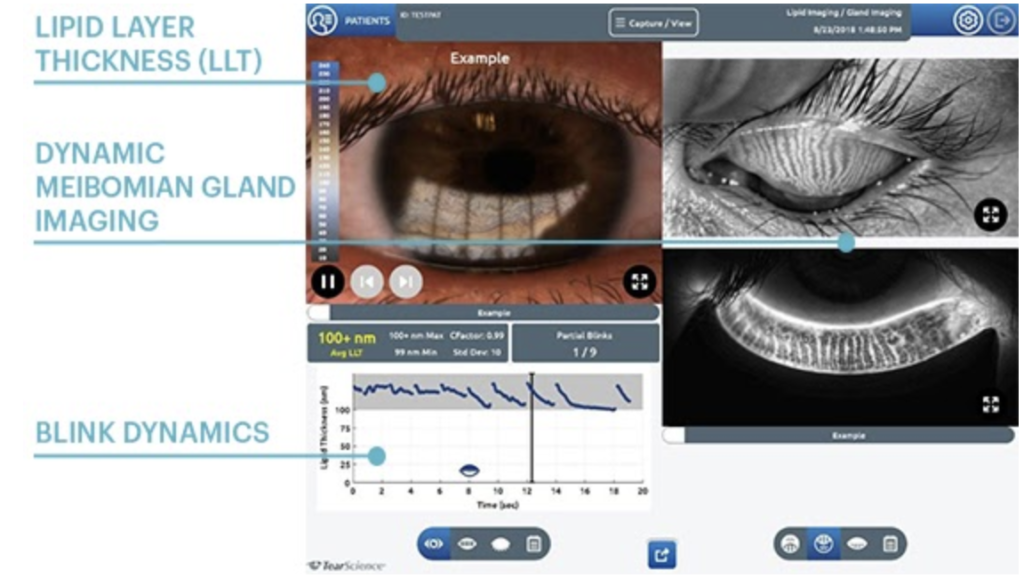 What a Dry Eye Exam Looks Like | Dr. Shaver - The Eye Center